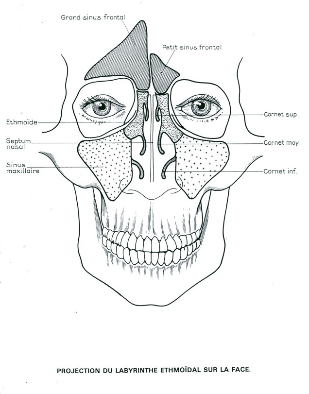 Chirurgie sinus ethmoïdal , ethmoïdectomie